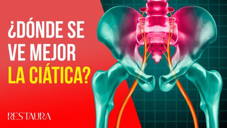 Cómo se Ve la Ciática en una Radiografía: Signos Clave y Diagnóstico ...